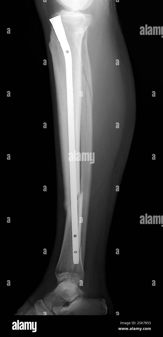 X-ray (side view) of the left leg of a female patient, showing multiple ...