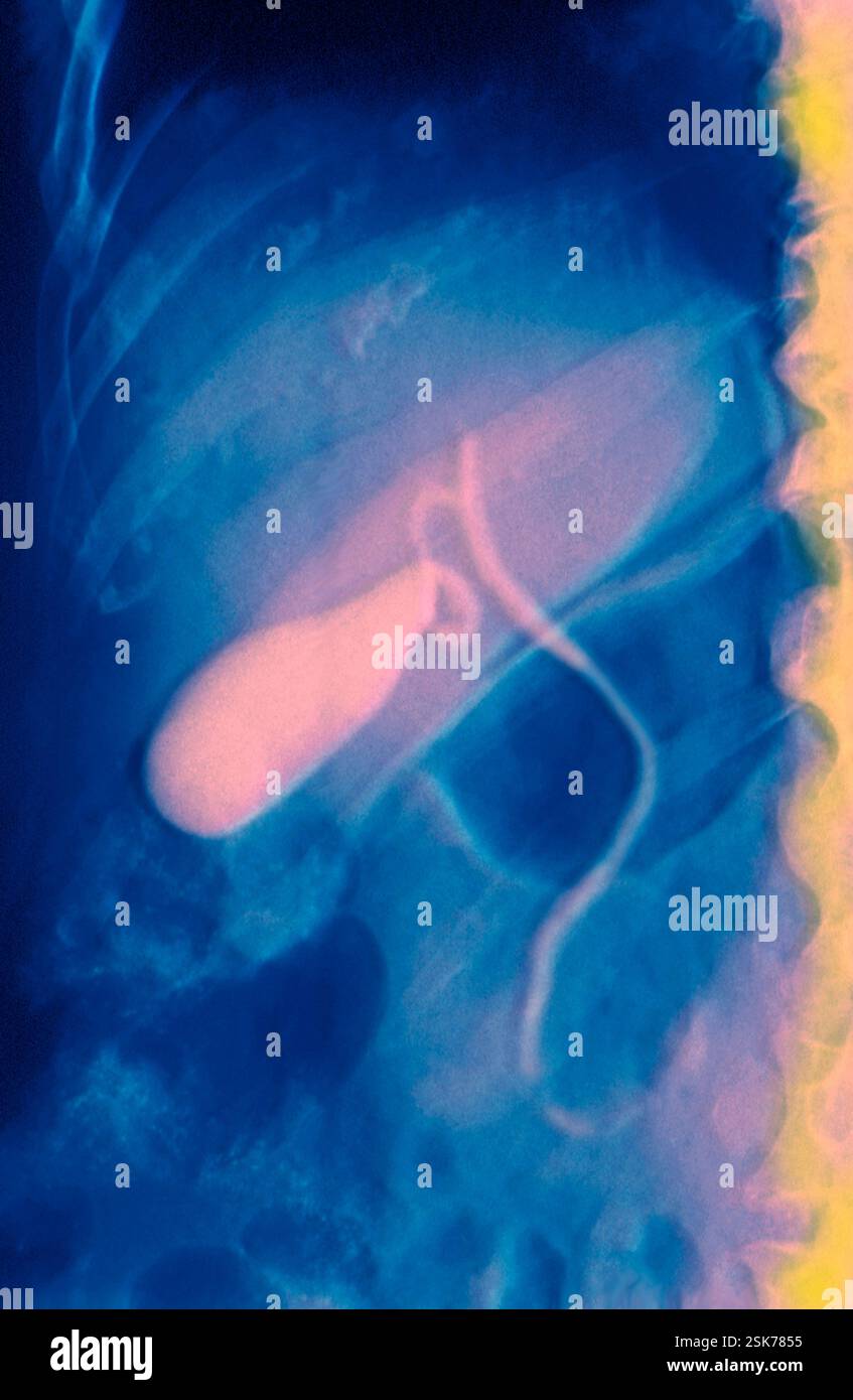 Coloured cholecystogram (X-ray) of the abdomen of a patient, showing a ...