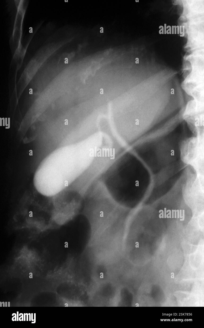 Cholecystogram (X-ray) of the abdomen of a patient, showing a healthy ...