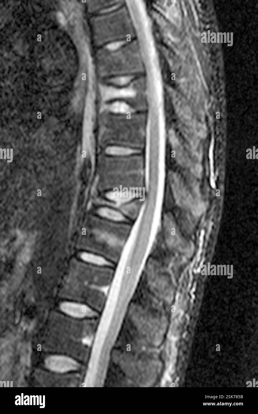 Magnetic Resonance Imaging (MRI) scan in sagittal section through the ...