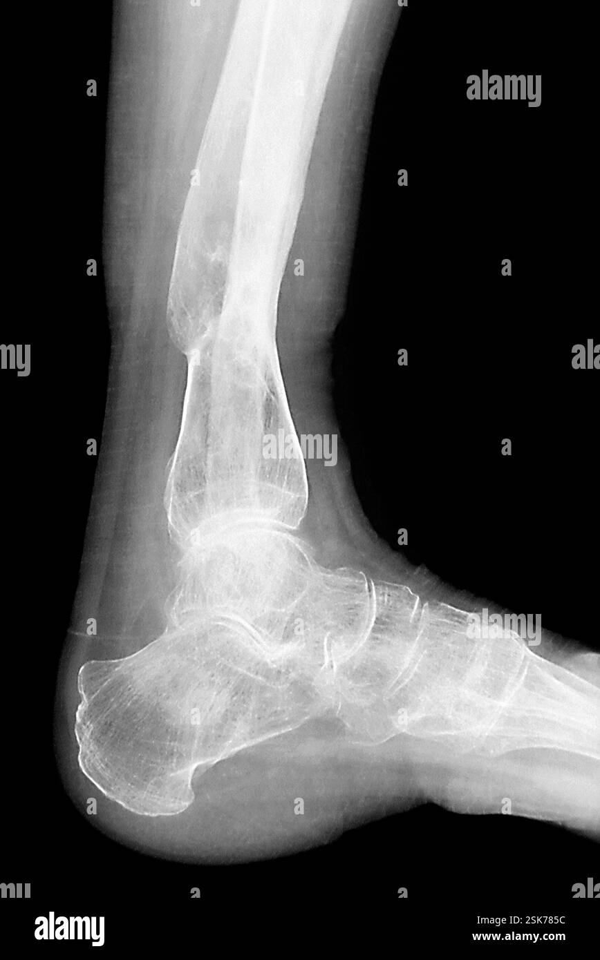 X-ray (side view) of the ankle of a patient aged 70, showing fusion ...
