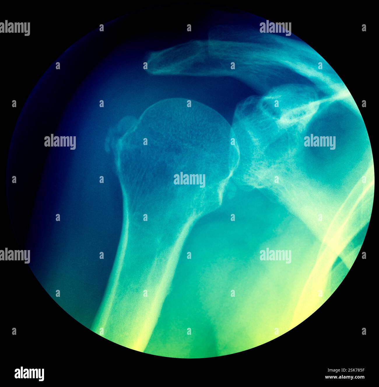 Coloured X-ray (front view) of the shoulder bones in a female patient ...