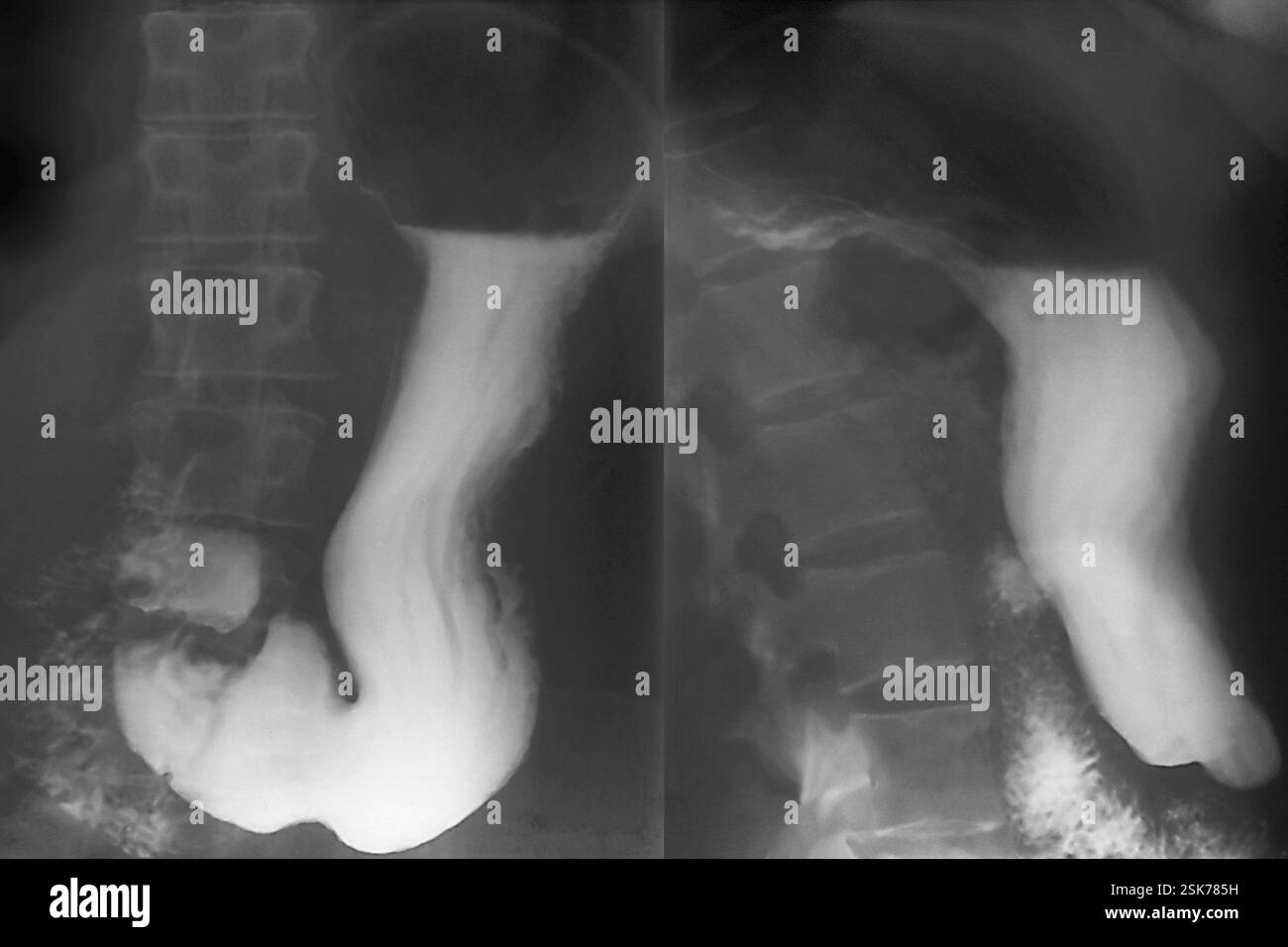 Barium X-ray in front view (at left) and side view (at right) of the ...