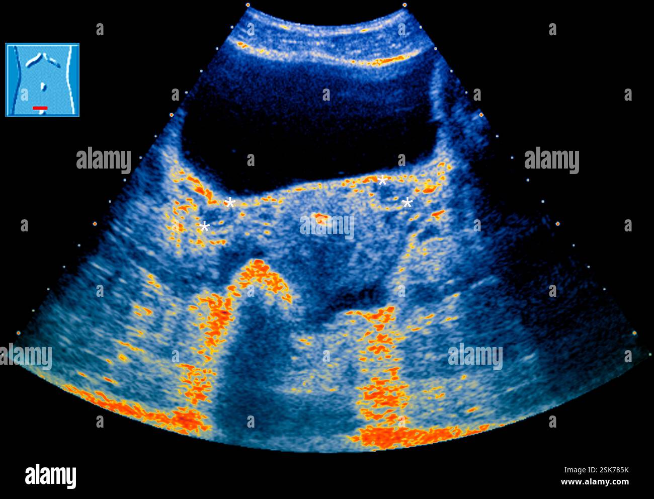 Coloured pelvic ultrasound image of a woman aged 27 on the 10th day of ...