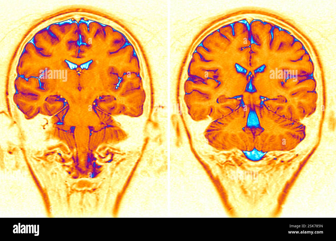 Coloured Magnetic Resonance Imaging (MRI) scan of two contiguous coronal sections of the brain ...