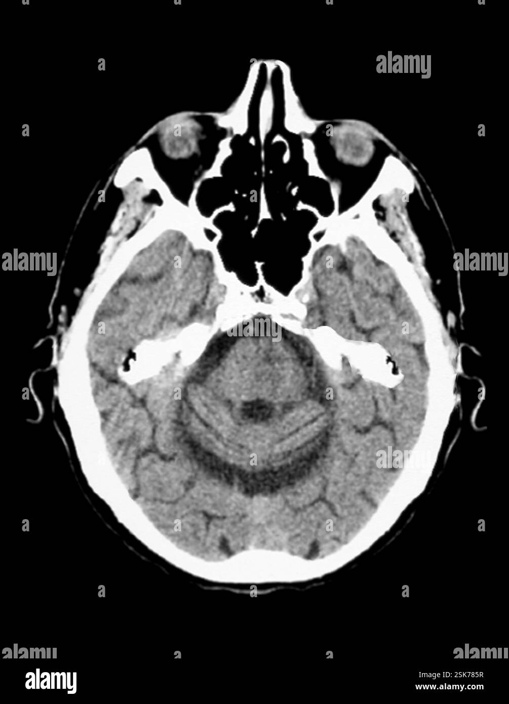 Computed tomography (CT) scan in axial section of the brain of a male ...