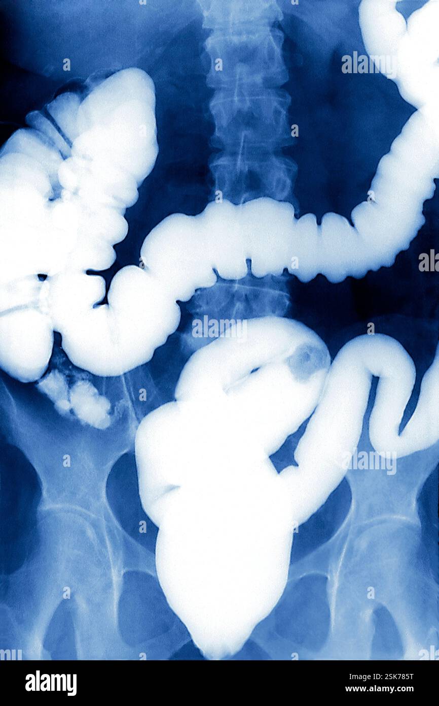 Coloured barium enema X-ray (front view) of the abdomen of a patient ...