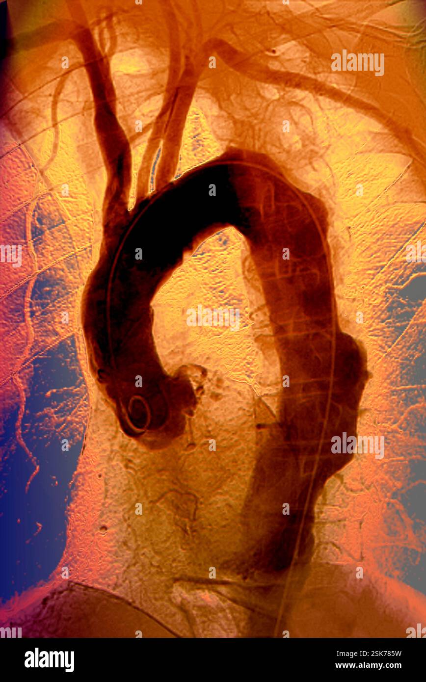 Coloured angiogram X-ray (anterior oblique view) of the blood vessels ...