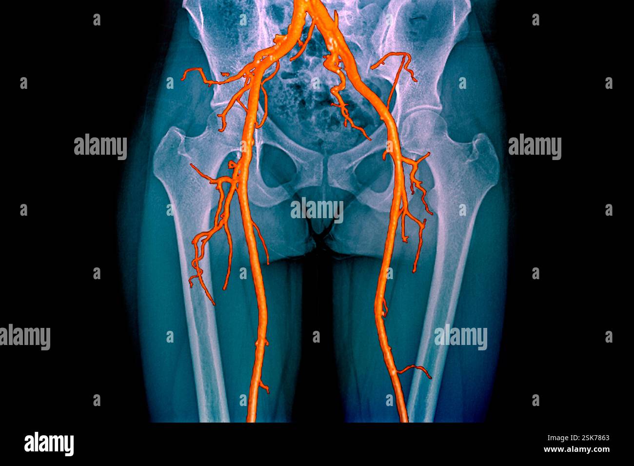 Three dimensional Computed Tomography (CT) scan (front view) of the ...