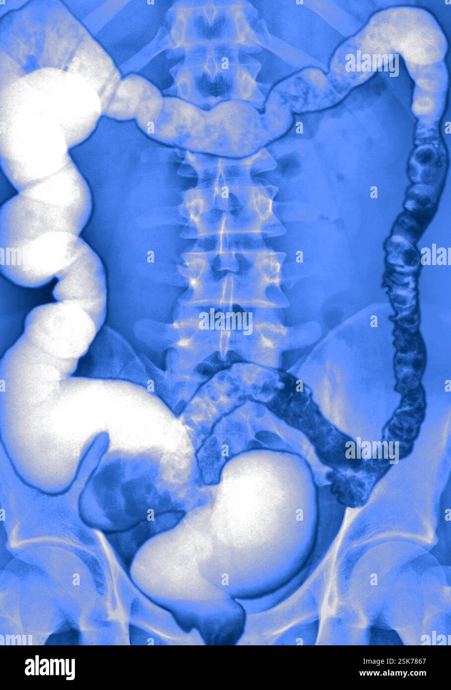 Coloured barium enema X-ray (front view) of the abdomen of a patient ...