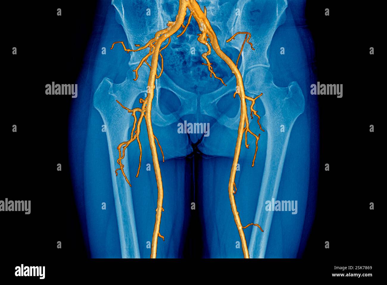 Three dimensional Computed Tomography (CT) scan (front view) of the ...
