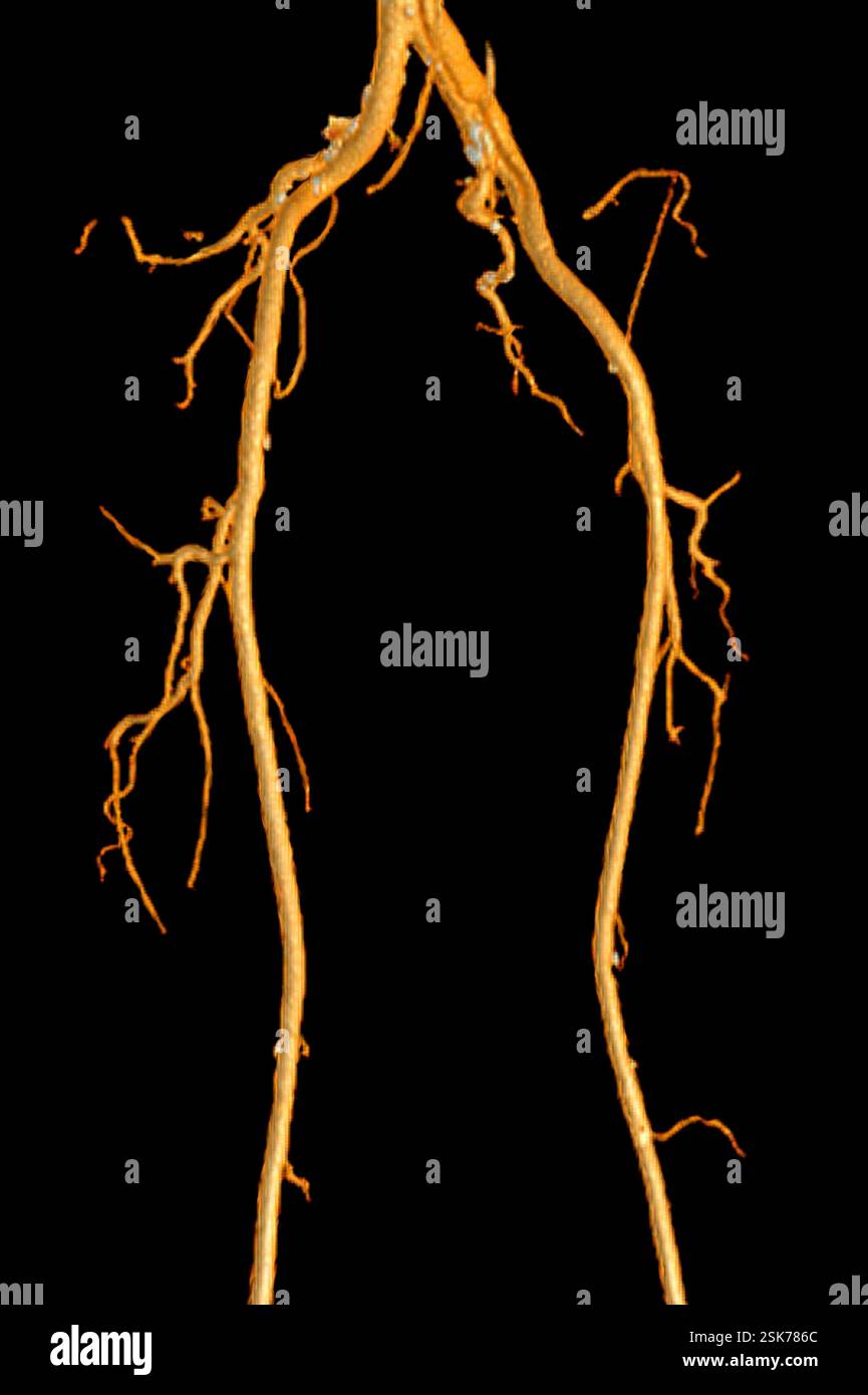 Three dimensional Computed Tomography (CT) scan (front view) of the ...