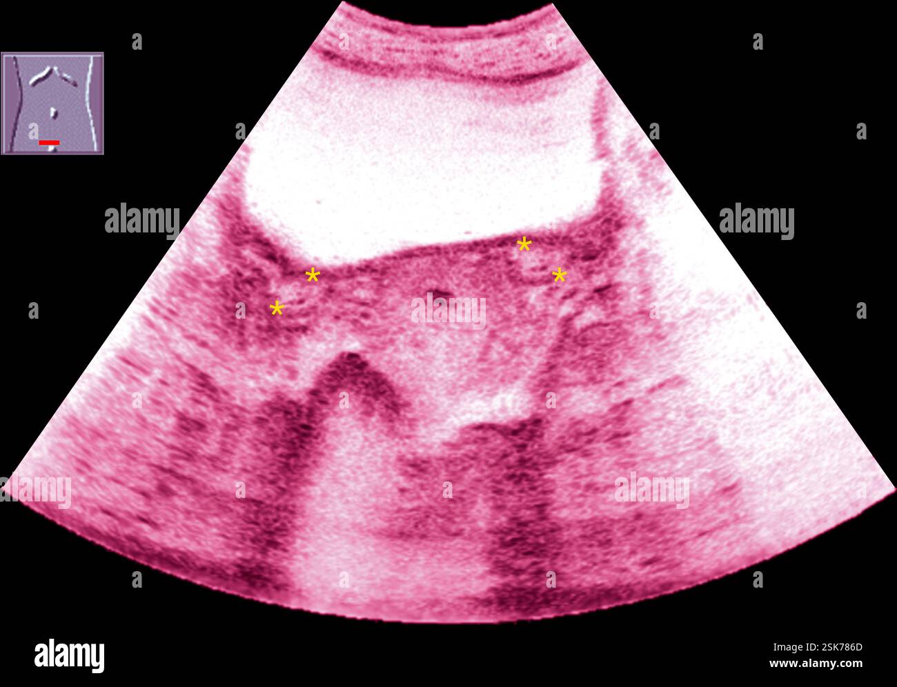 Coloured pelvic ultrasound image of a woman aged 27 on the 10th day of ...
