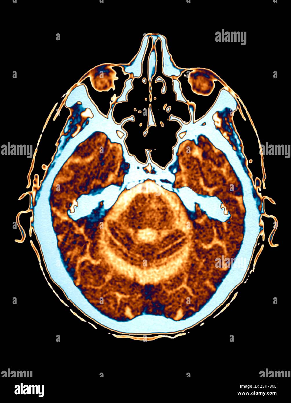 Coloured Computed tomography (CT) scan in axial section of the brain of a male patient aged 60 ...