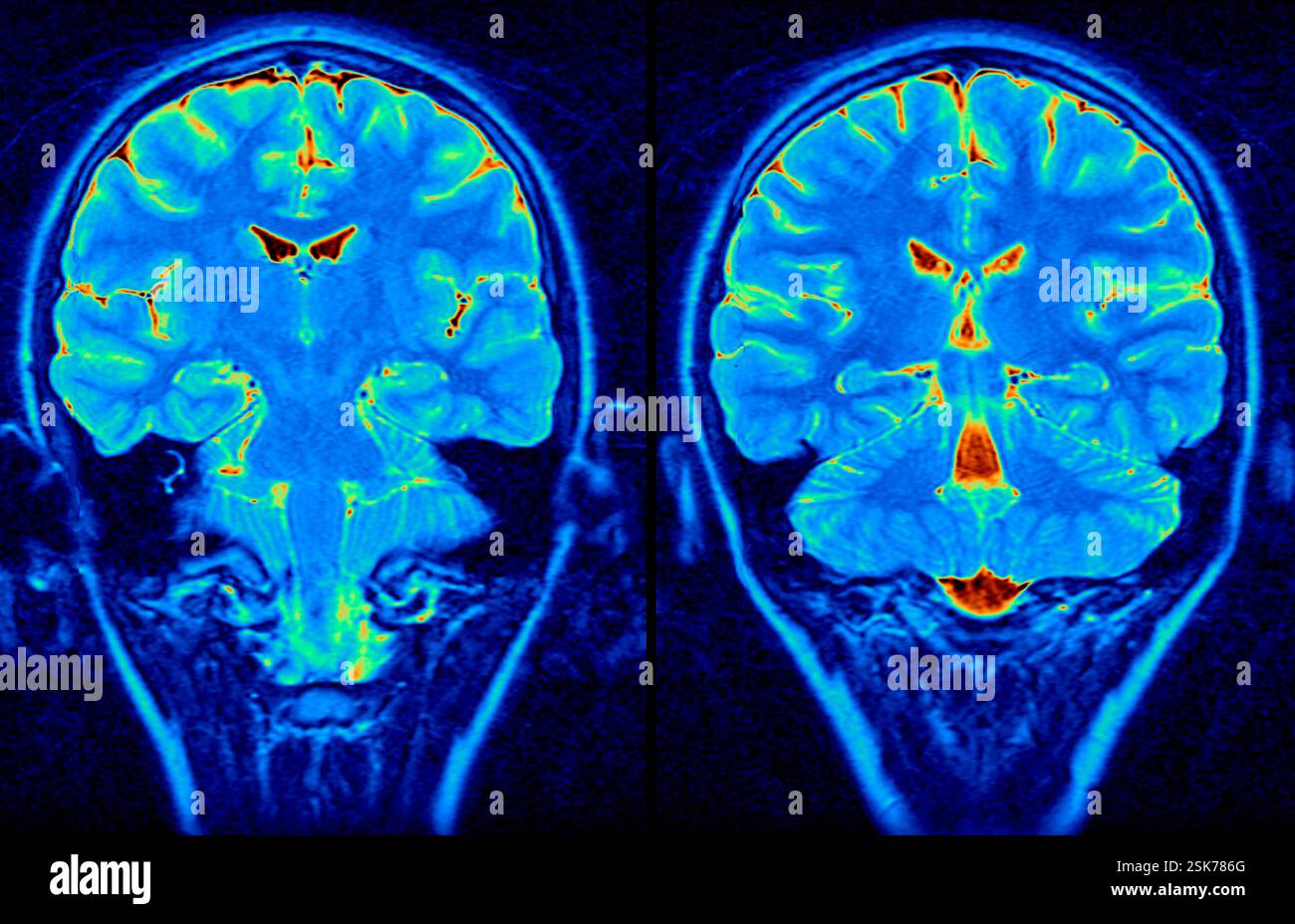 Coloured Magnetic Resonance Imaging (MRI) scan of two contiguous coronal sections of the brain ...