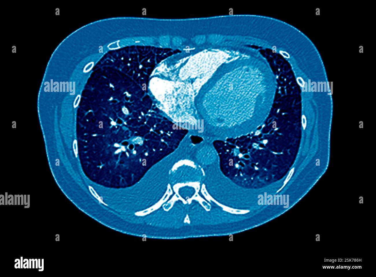 Coloured Computed Tomography (CT) scan in axial section through the chest of a female patient ...