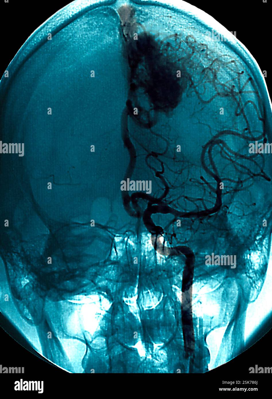 Coloured digital angiogram (X-ray) of the brain in front view, showing ...