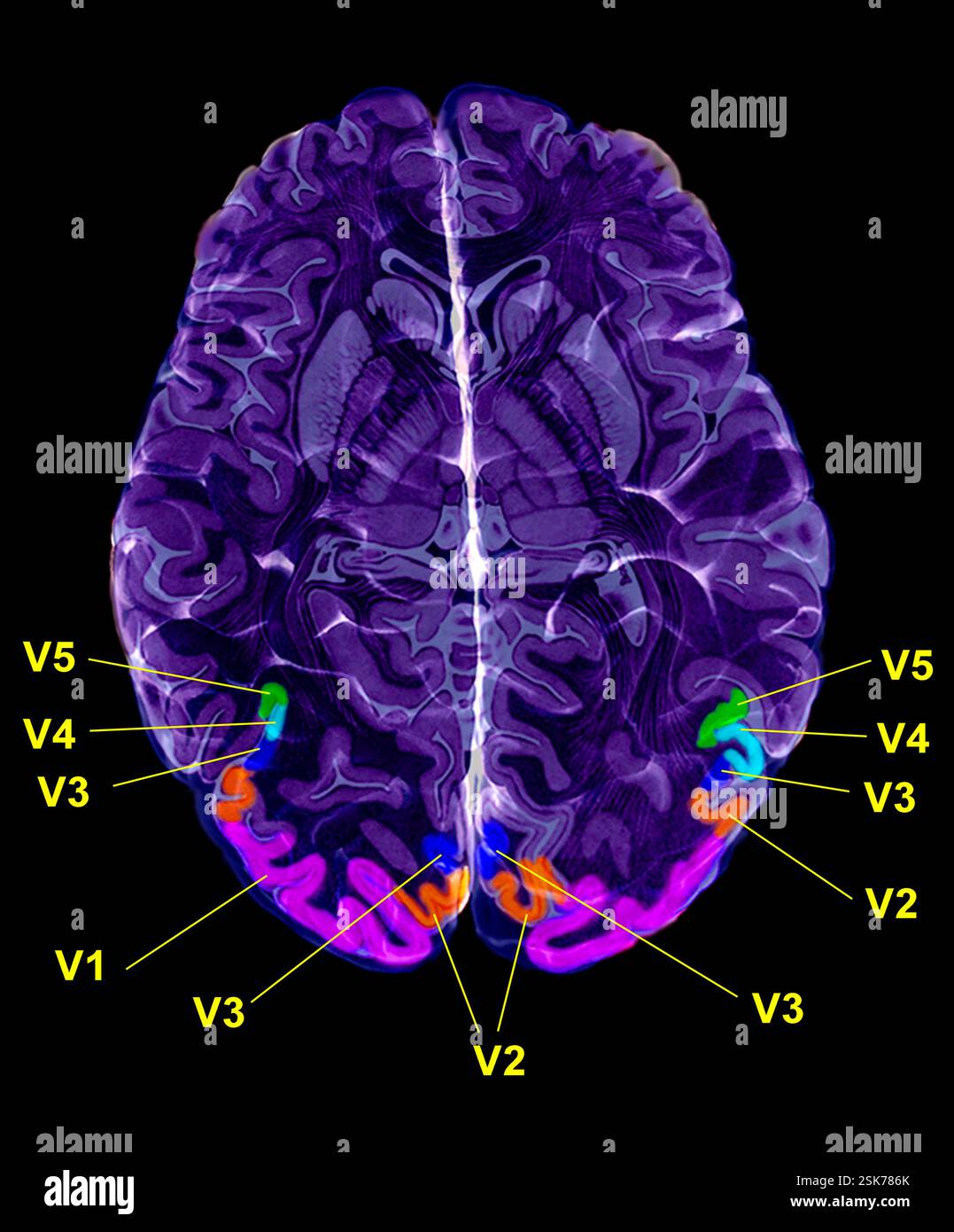 Coloured three-dimensional Magnetic Resonance Imaging (MRI) scan in axial section of the brain ...