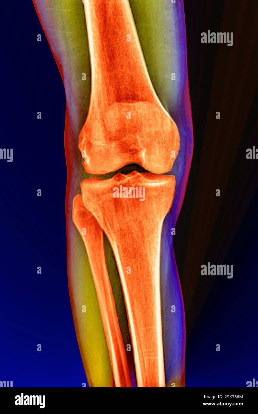 Coloured X-ray (front view) of the leg of a patient aged 34, showing a ...