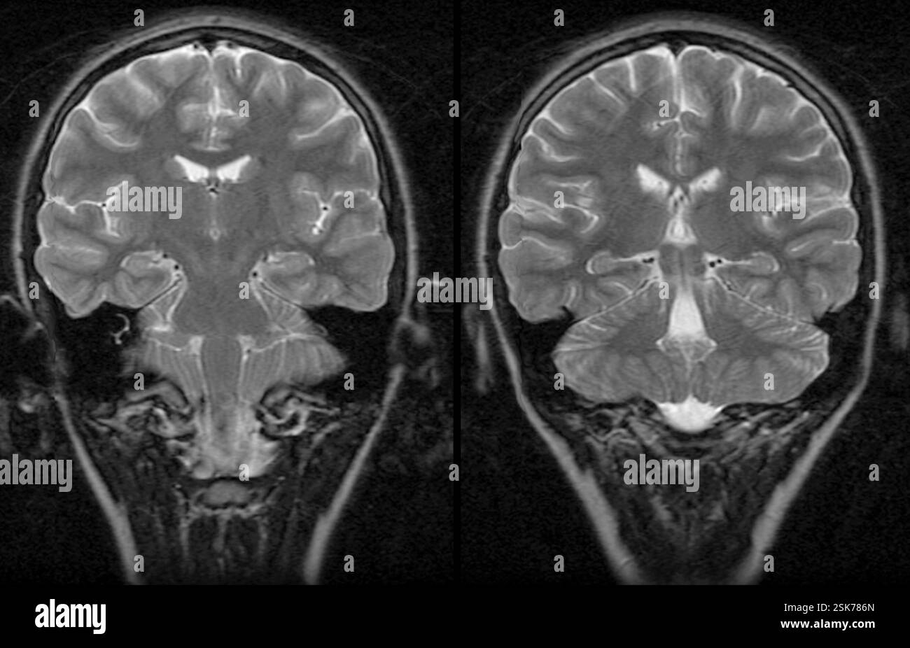 Magnetic Resonance Imaging (MRI) scan of two contiguous coronal ...