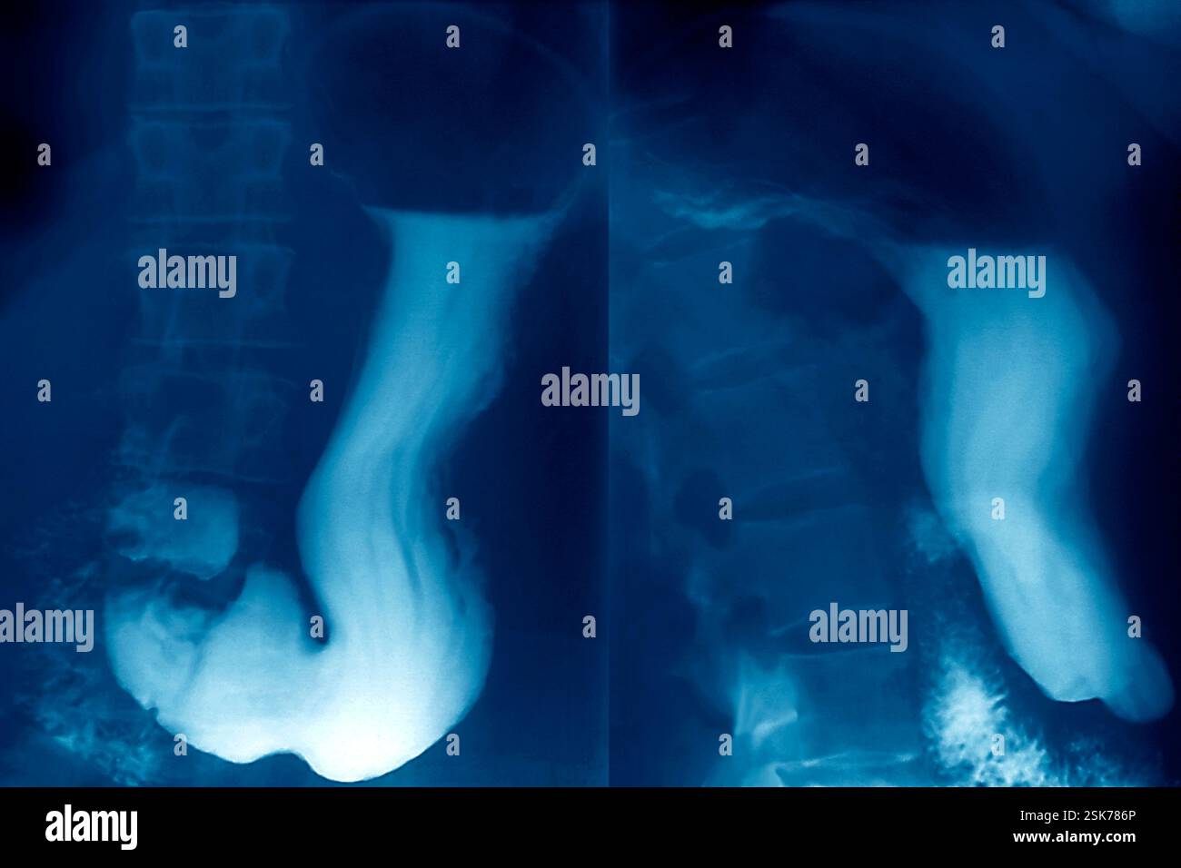 Coloured Barium X-ray in front view (at left) and side view (at right ...