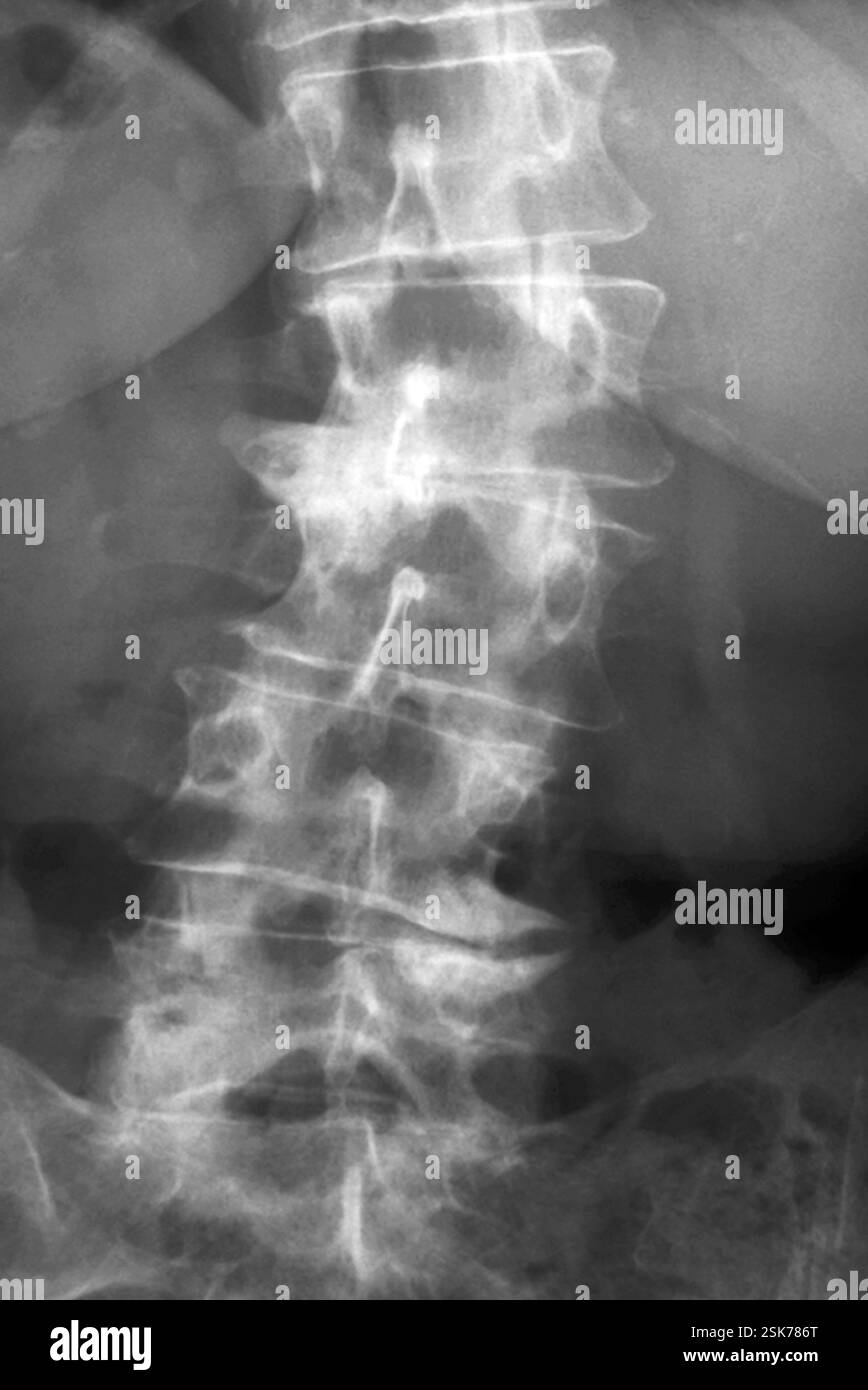 X-ray (front view) of the lower back of a female patient, showing ...