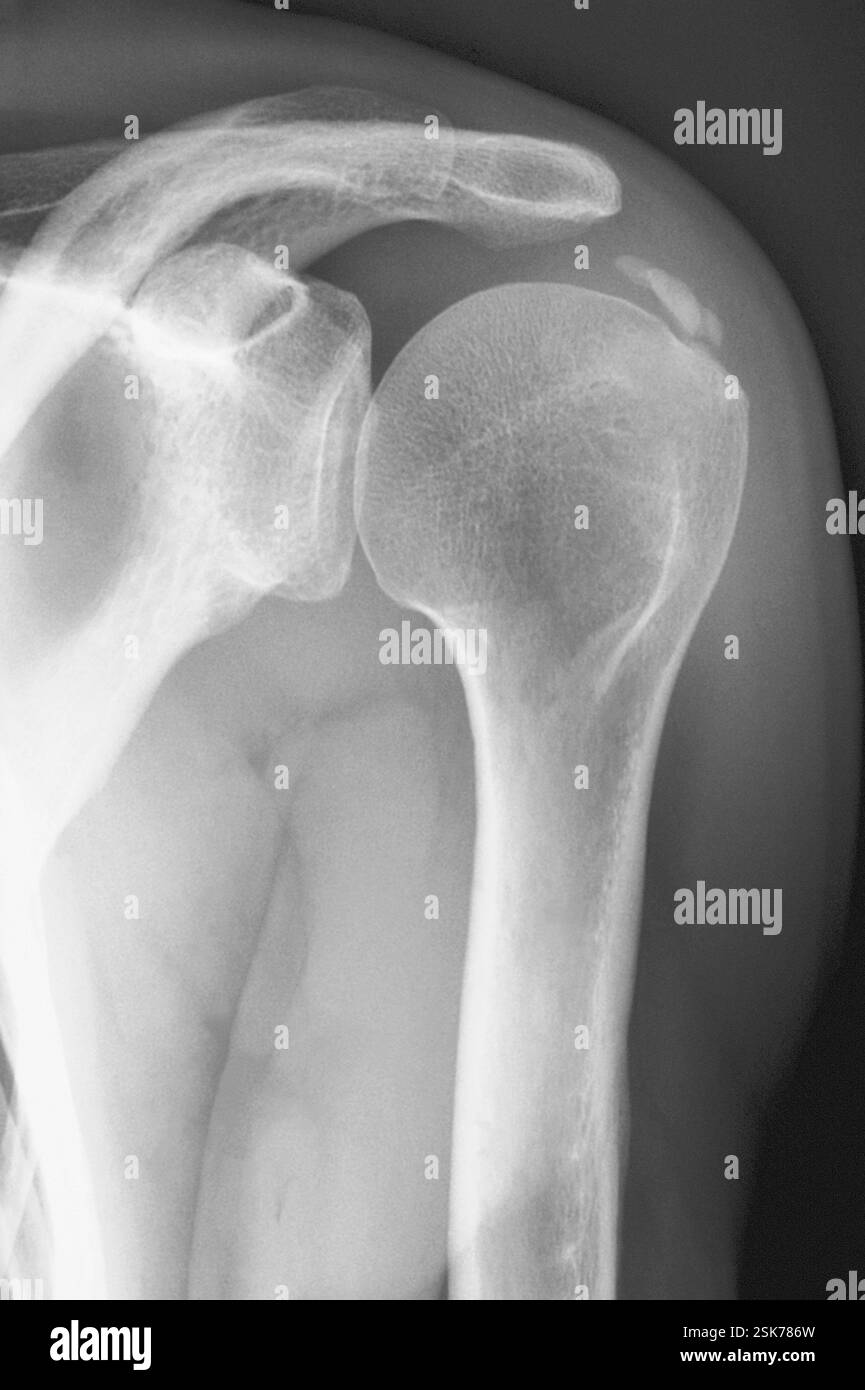 X-ray (front view) of the shoulder joint of a female patient aged 47 ...