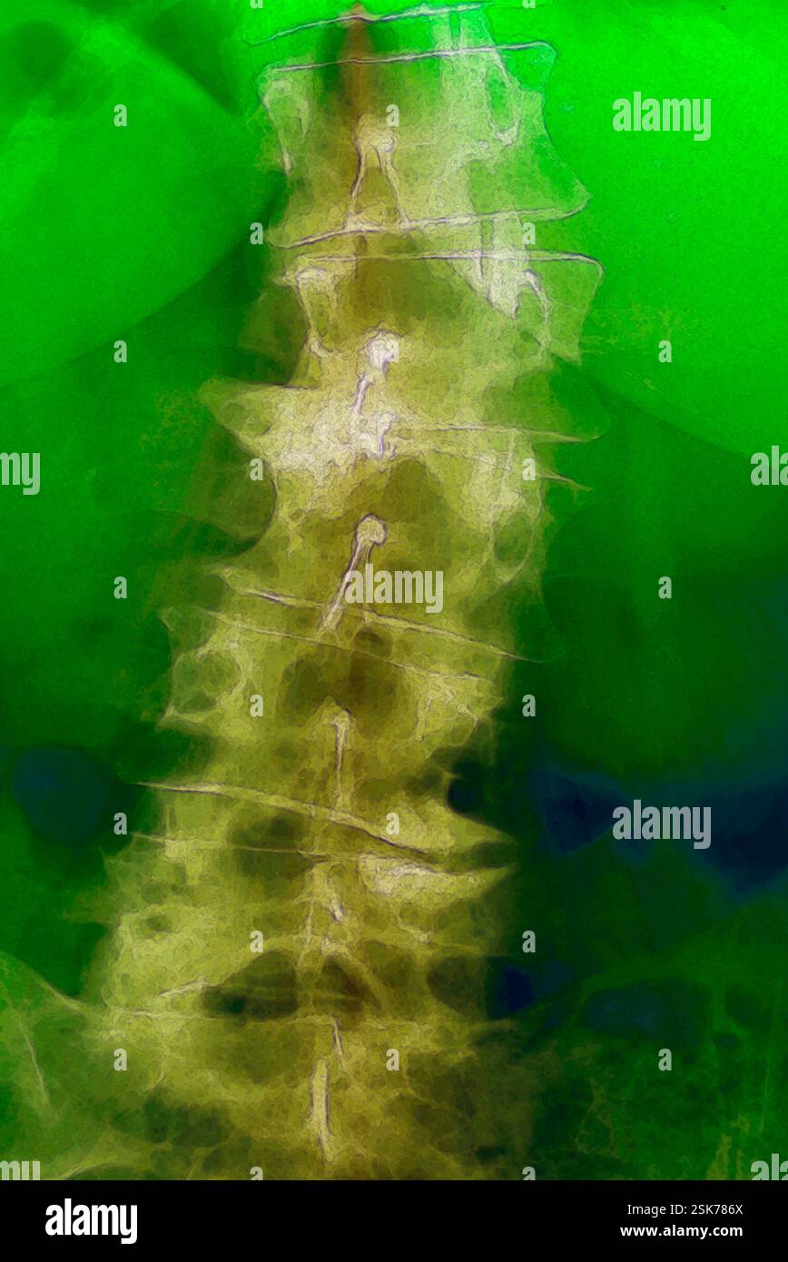 Coloured X-ray (front view) of the lower back of a female patient ...