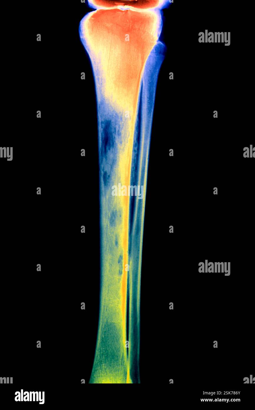 Coloured X-ray (front view) of the left leg of a male patient, showing ...