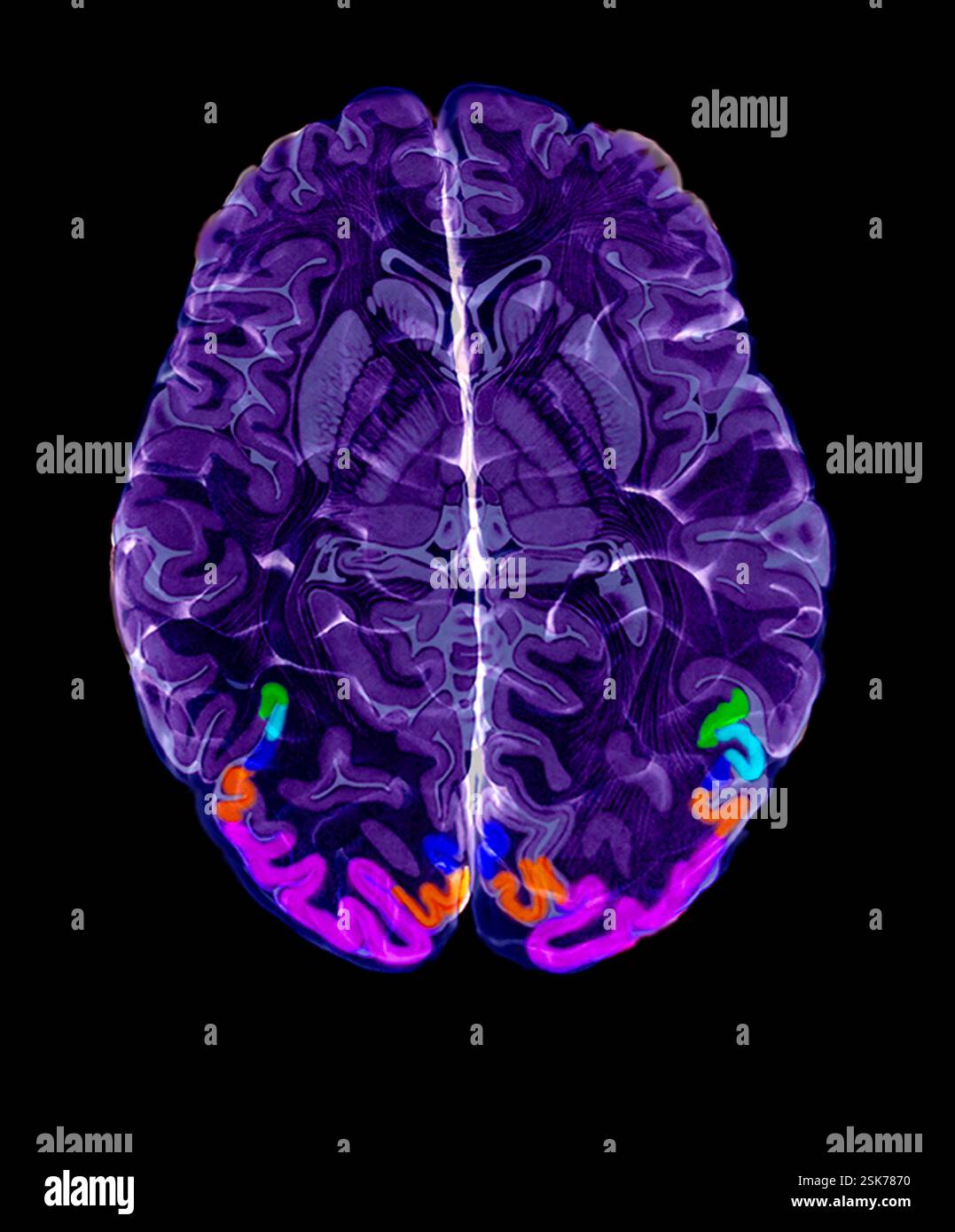 Coloured three-dimensional Magnetic Resonance Imaging (MRI) scan in axial section of the brain ...