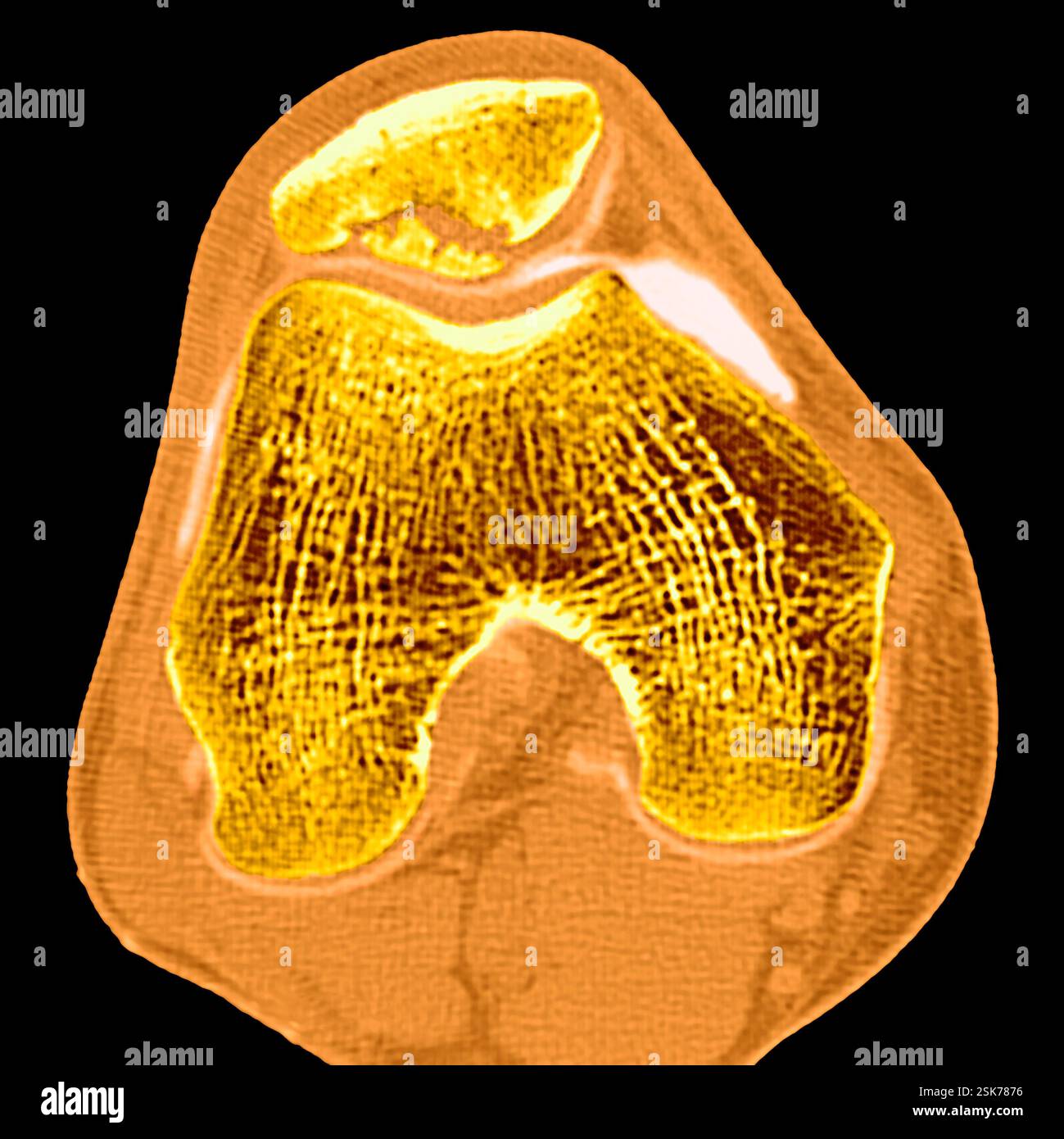 Coloured Computed Tomography (CT) scan (axial section) of the knee of a ...