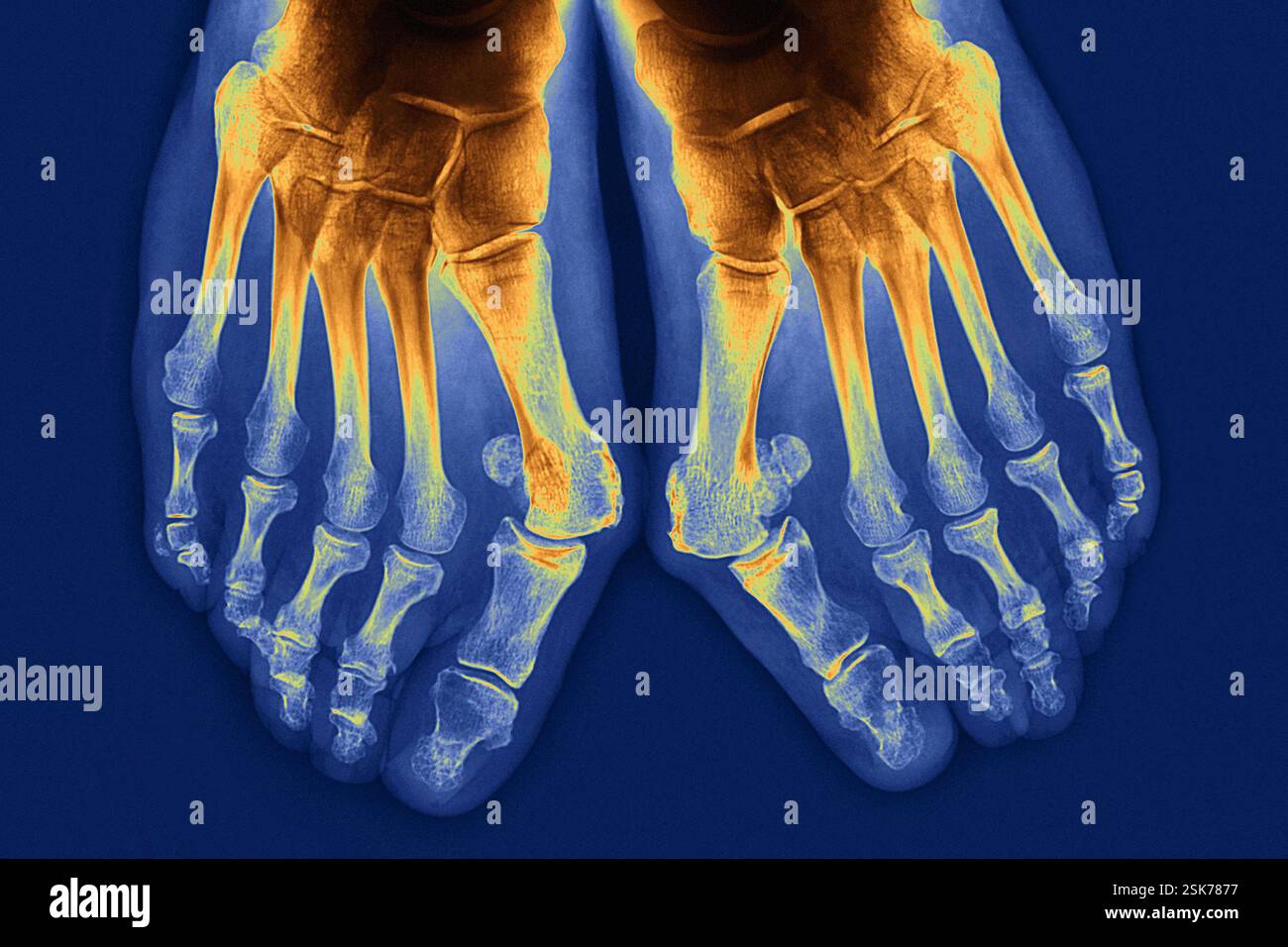 Coloured X-ray (top view) of the feet of a female patient aged 69 ...