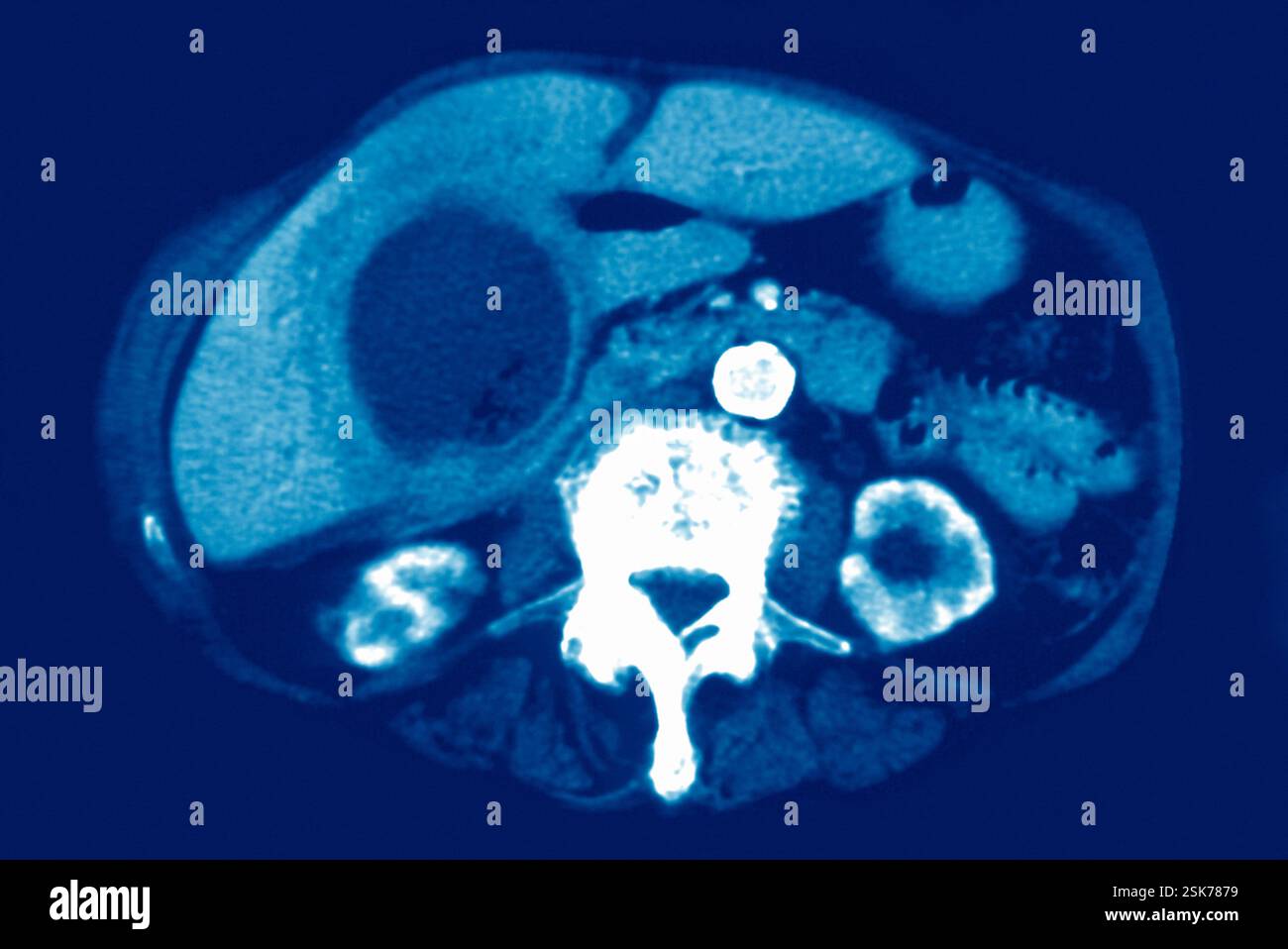 Coloured Computed Tomography (CT) scan in axial section through the abdomen of a female patient ...