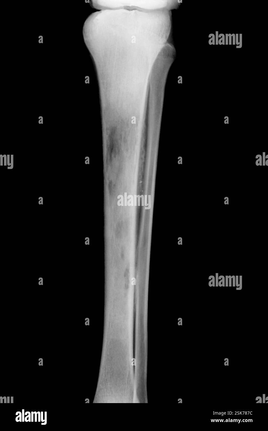 X-ray (front view) of the left leg of a male patient, showing ...