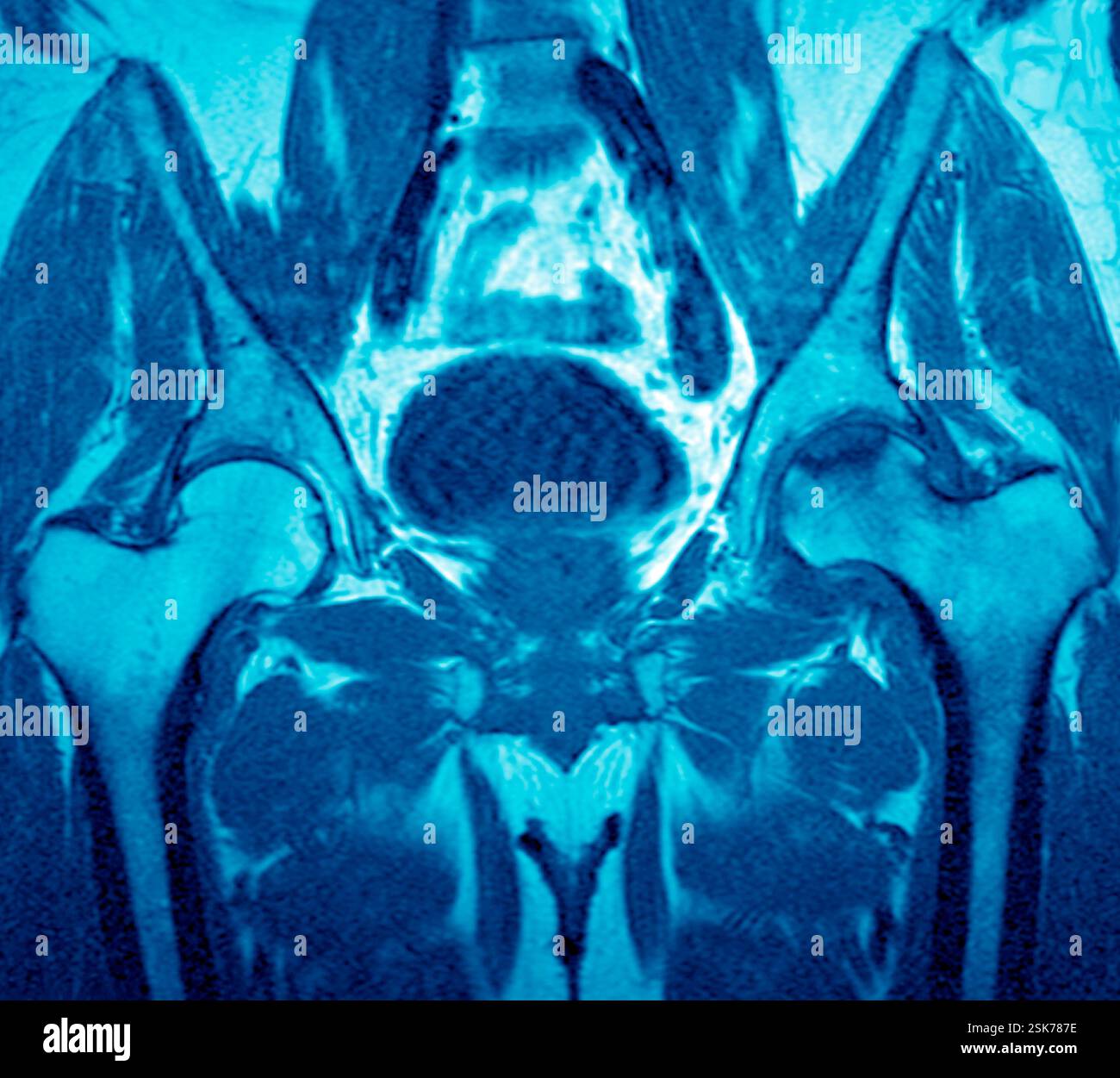 Coloured Magnetic Resonance Imaging (MRI) scan in front view of the hip ...