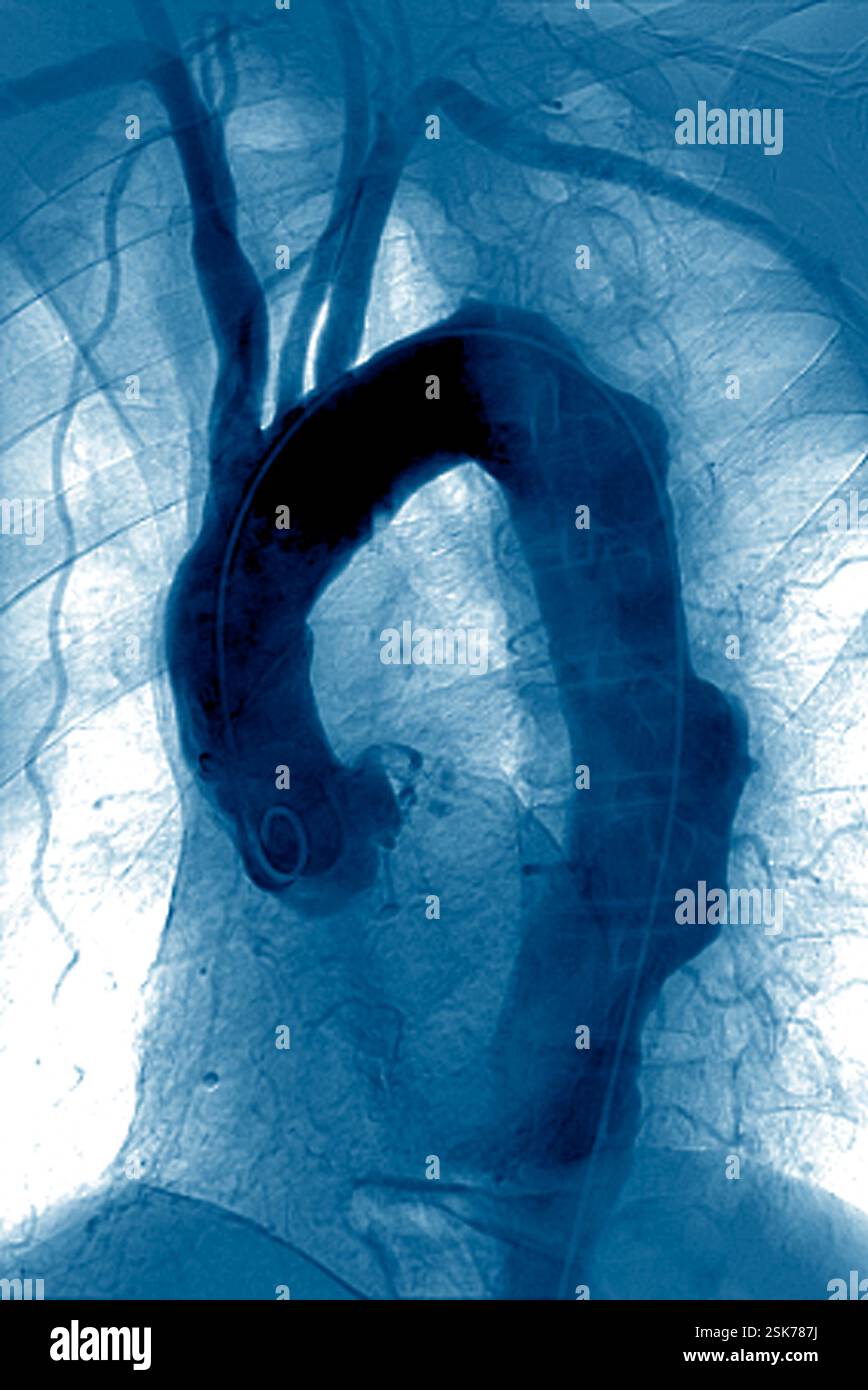 Coloured angiogram X-ray (anterior oblique view) of the blood vessels ...
