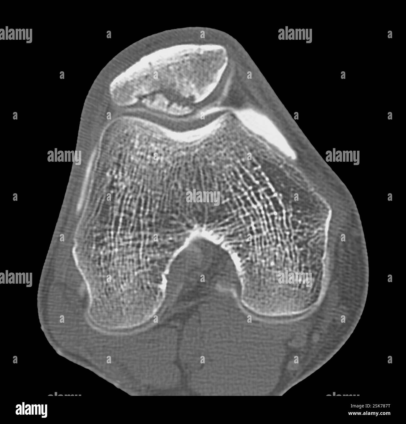 Computed Tomography (CT) scan (axial section) of the knee of a male ...