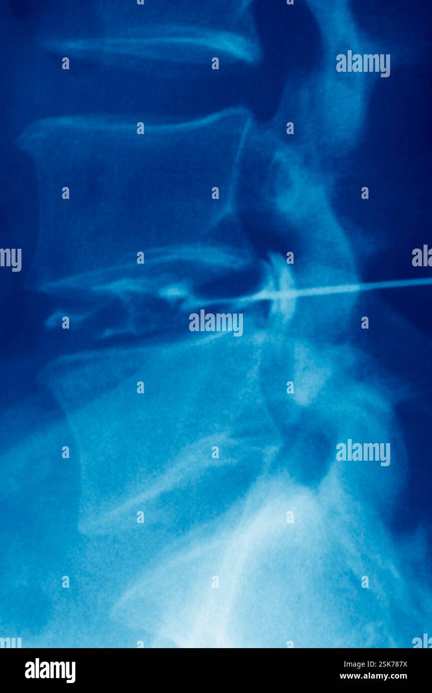 Coloured X-ray discography (side view) of the lumbar spine of a patient ...