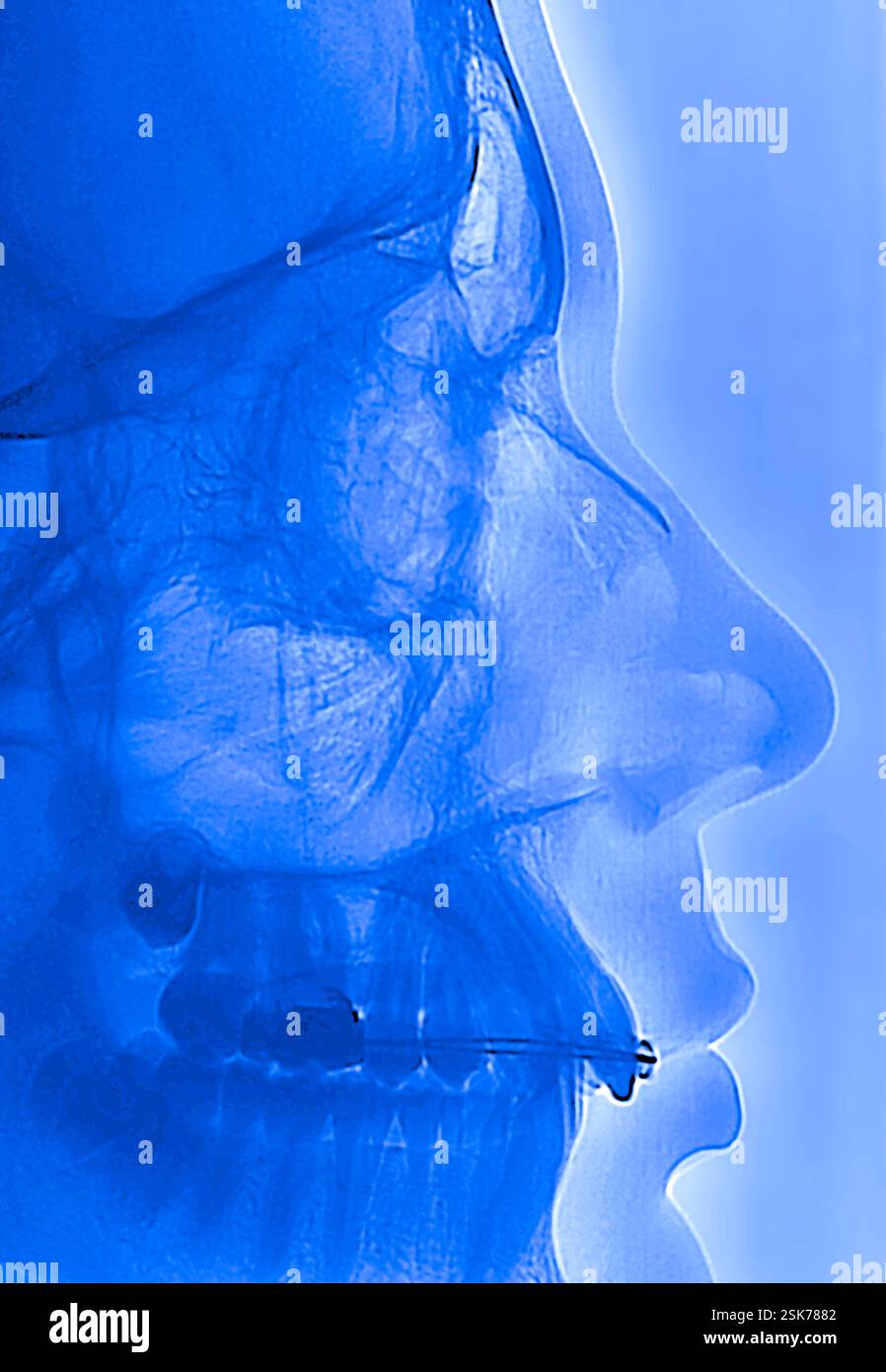 Coloured cephalometric X-ray in side view of the skull of a patient ...