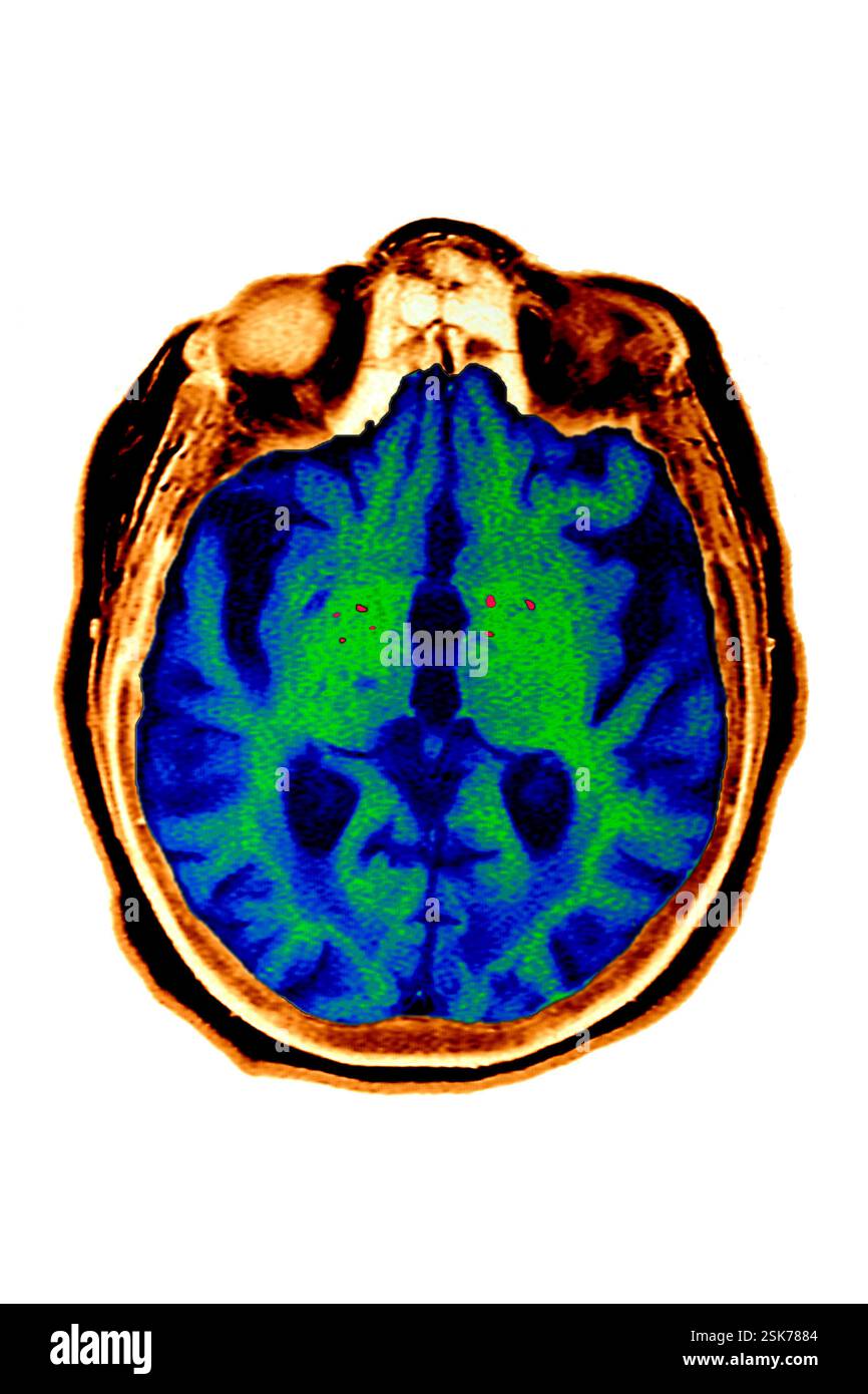 Coloured Magnetic Resonance Imaging (MRI) scan of an axial section ...