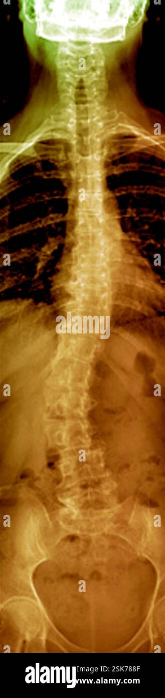 Coloured X-ray (front view) of the whole spine of a 40 year old patient ...