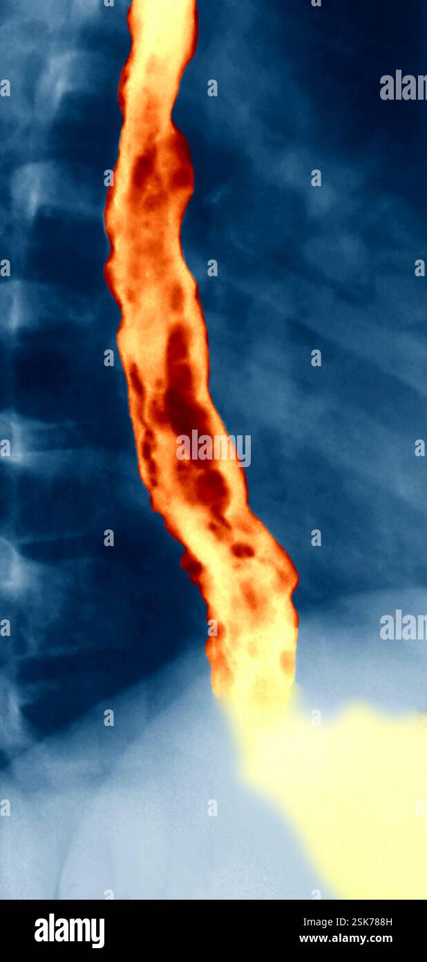 Coloured barium X-ray (oblique view) of the oesophagus of a young ...