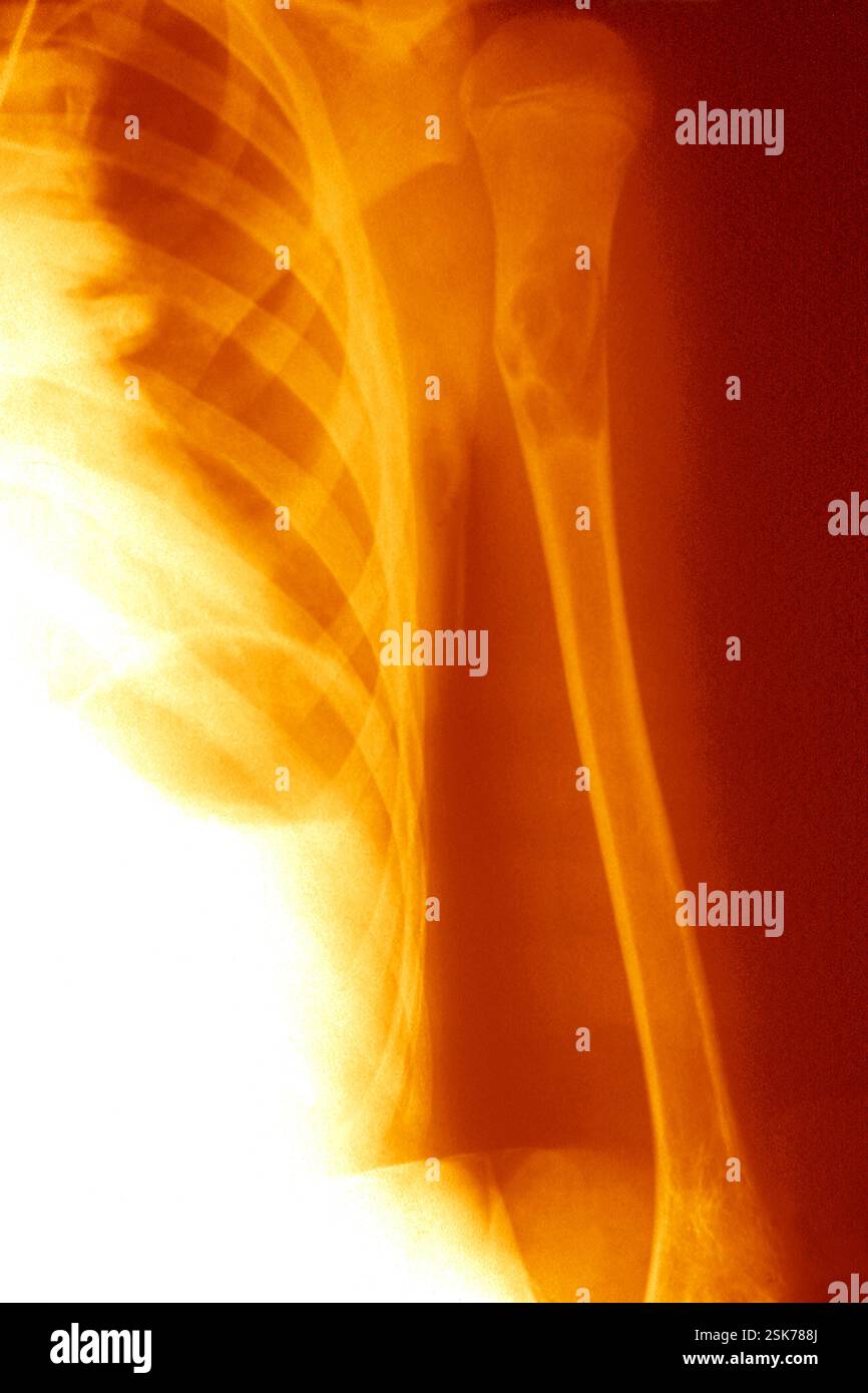 Coloured X-ray in front view of the arm (humerus) of a young patient ...