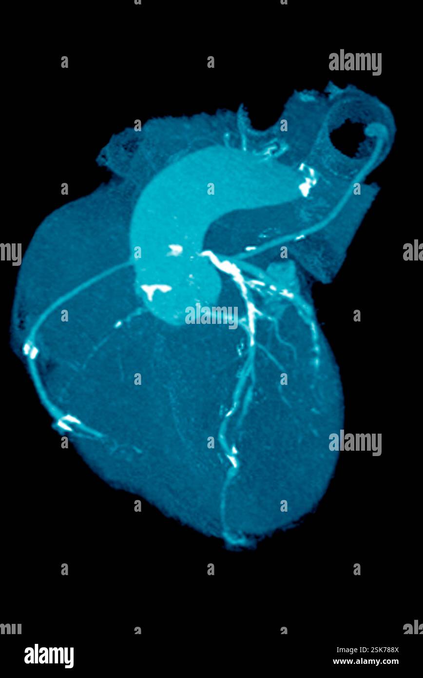 Coloured three-dimensional Computed Tomography (CT) angio scan of the ...