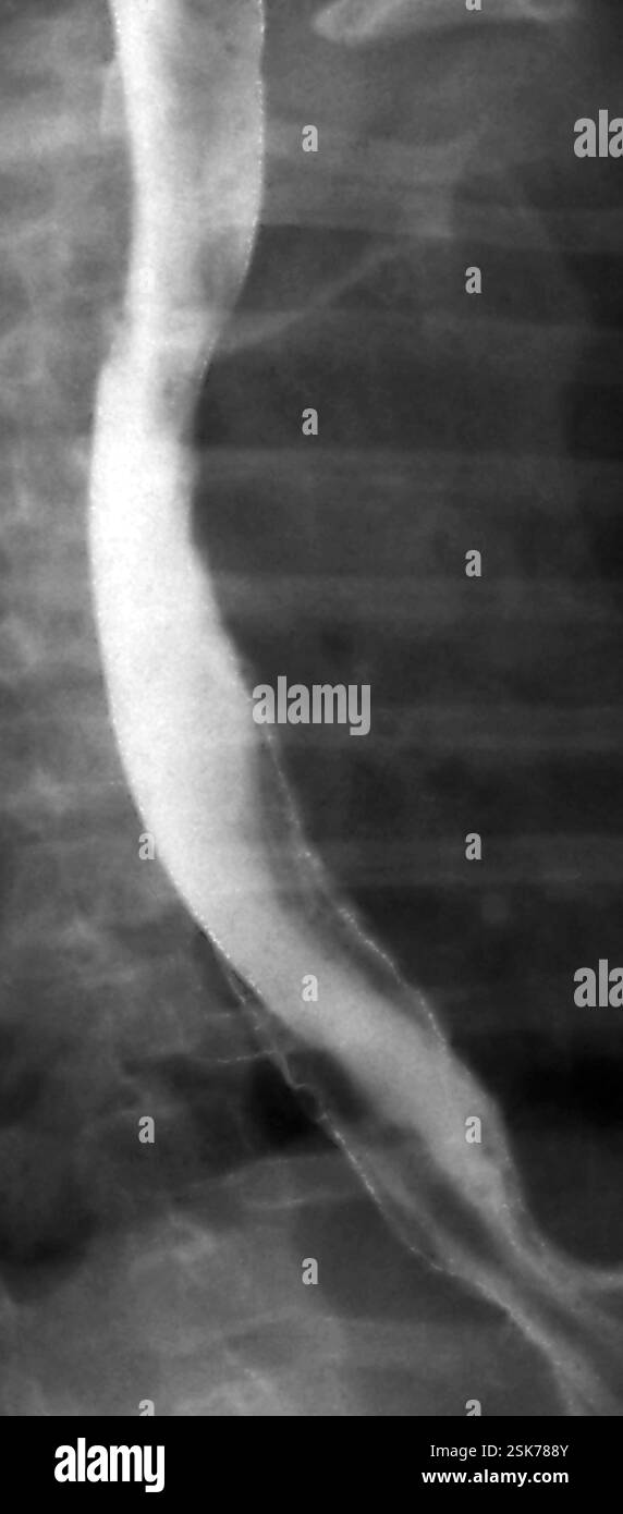 Barium X-ray (oblique view) of the healthy oesophagus of a young ...