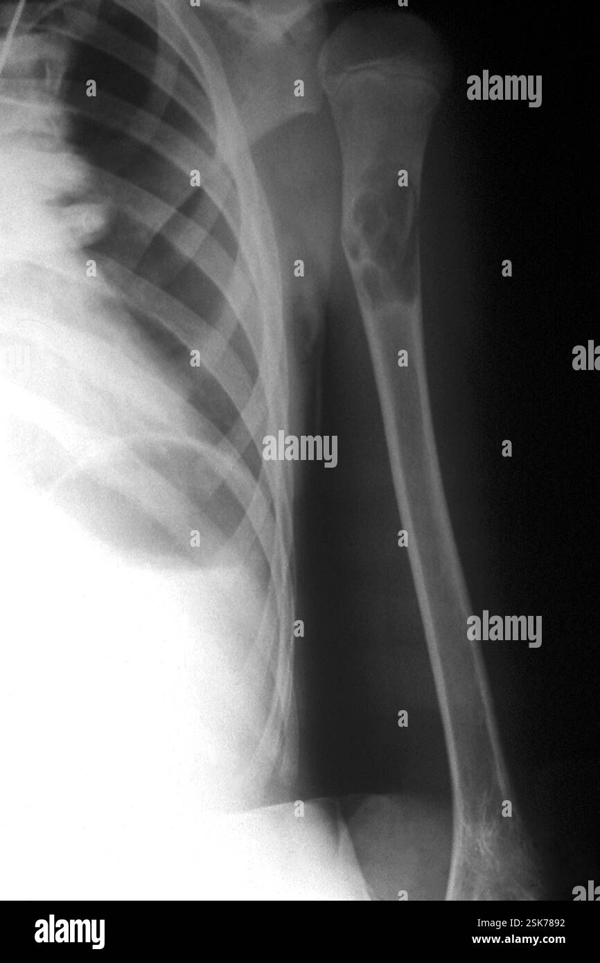 X-ray in front view of the arm (humerus) of a young patient, showing a ...