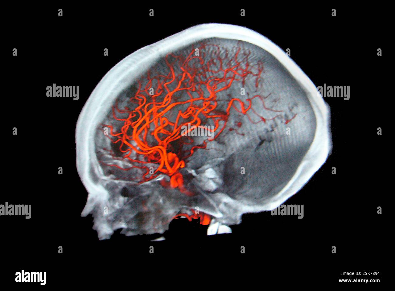Coloured three-dimensional Computed Tomography (CT) angio scan in side ...