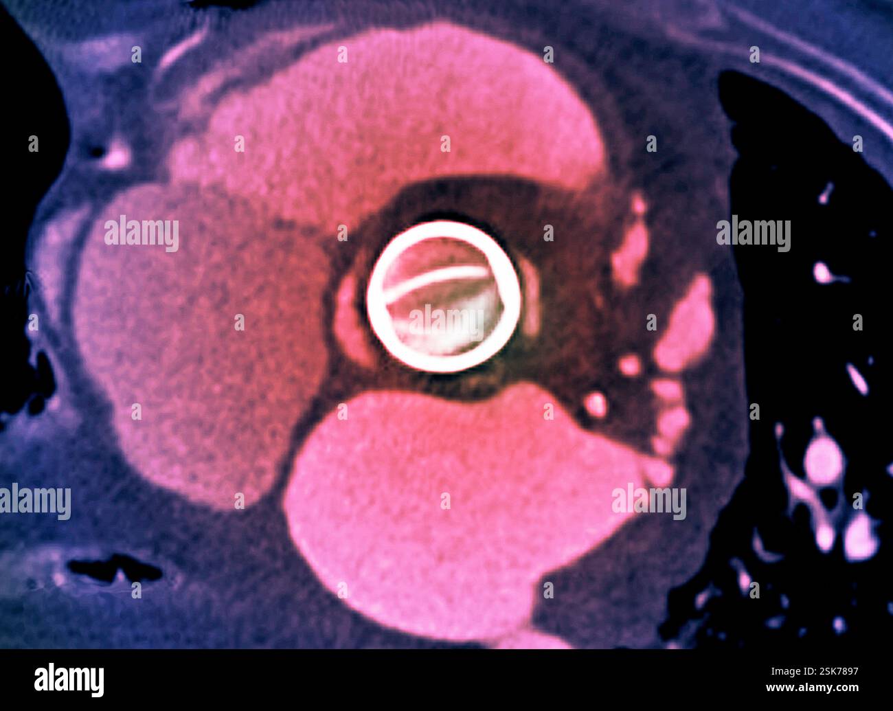 Coloured two-dimensional Computed Tomography (CT) angio scan through ...