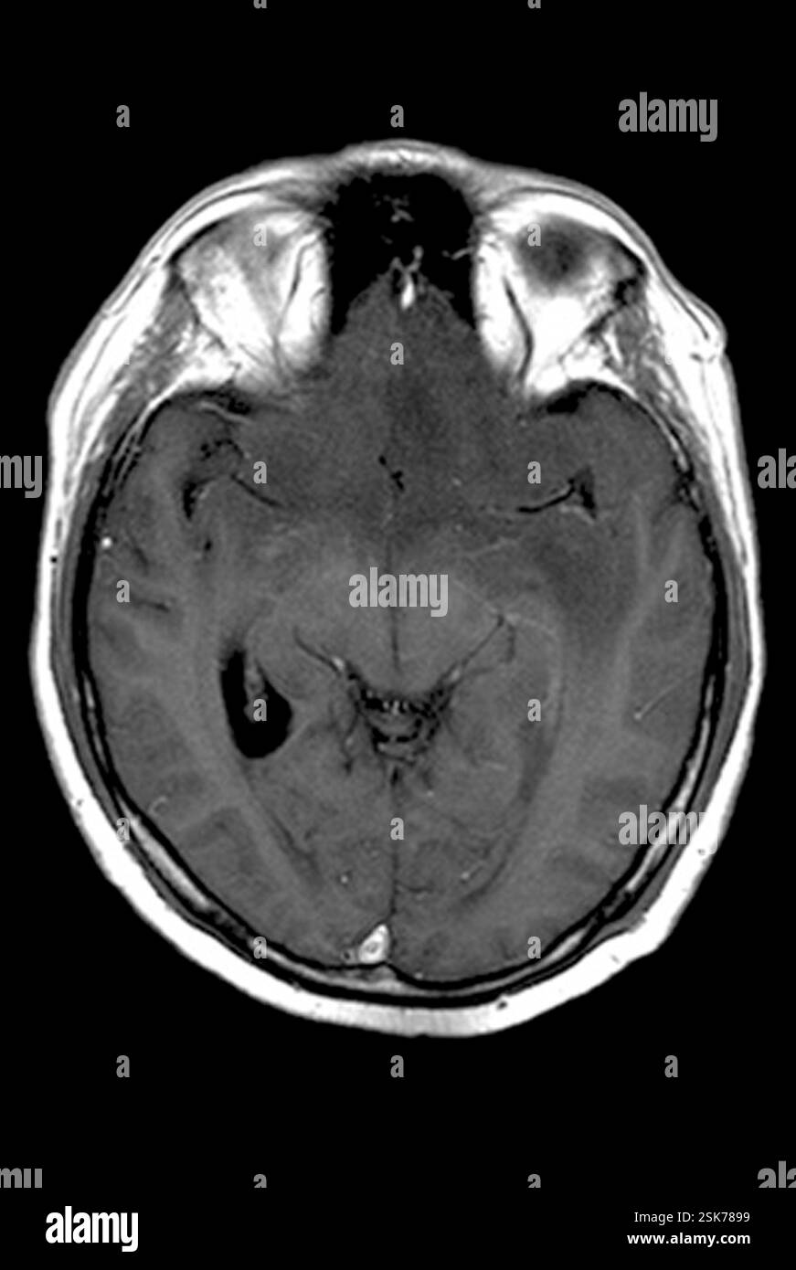 Magnetic Resonance Imaging (MRI) scan of an axial section through the ...