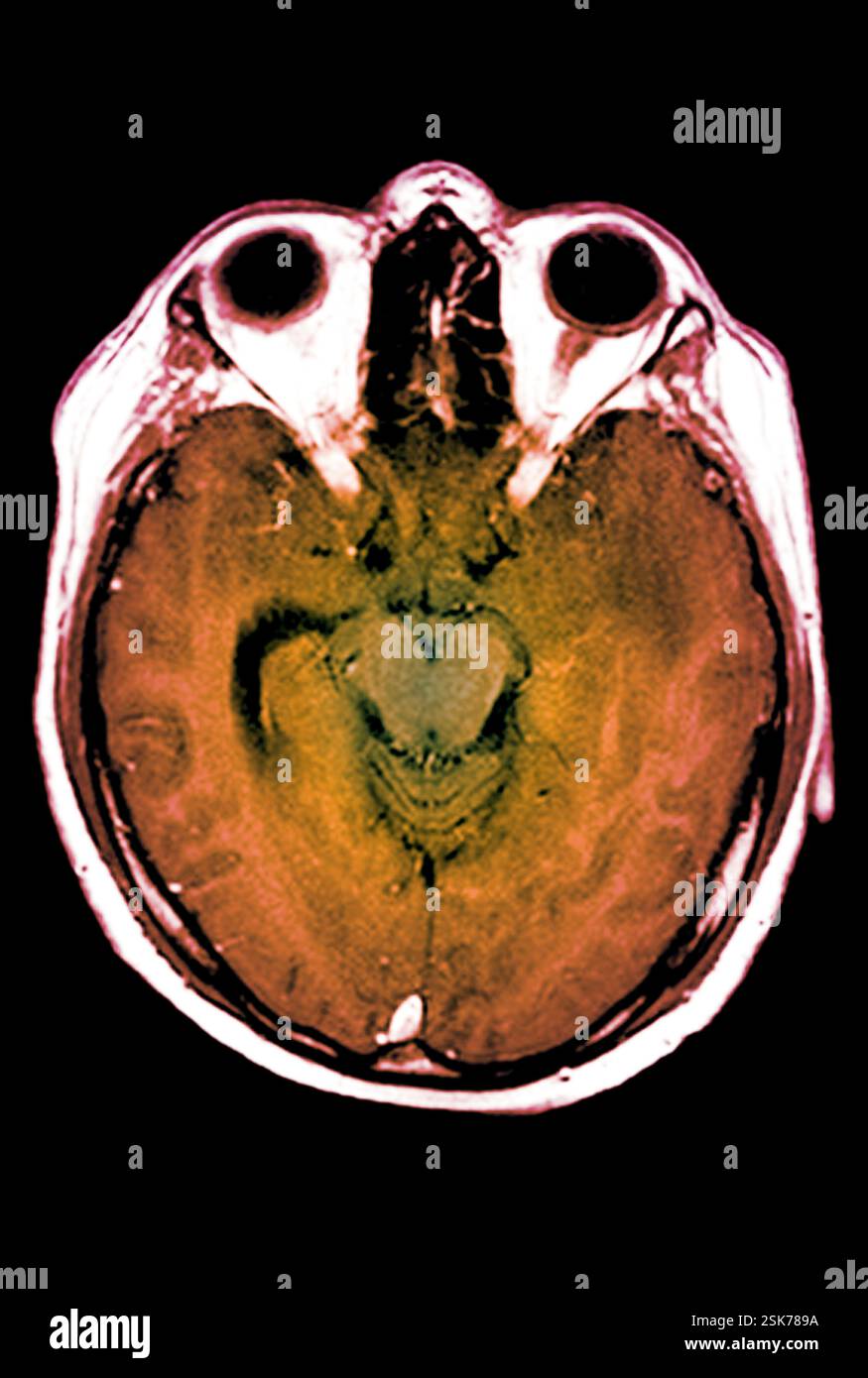 Coloured Magnetic Resonance Imaging (MRI) scan of an axial section ...